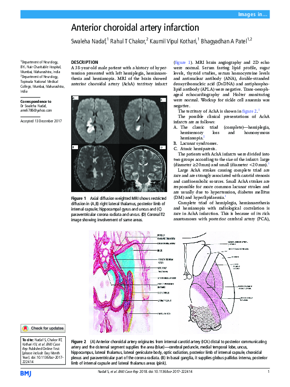 (PDF) Anterior choroidal artery infarction