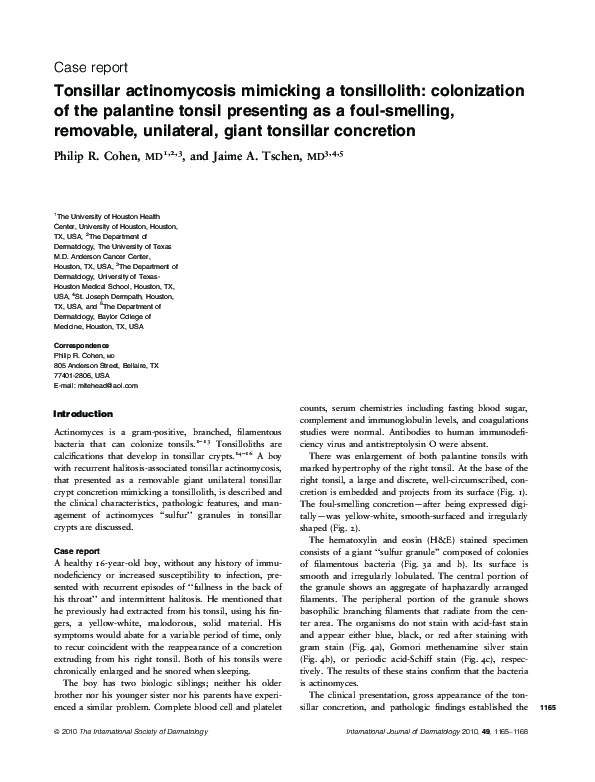 (PDF) Tonsillar actinomycosis mimicking a tonsillolith: colonization of ...