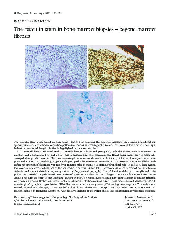 (PDF) The reticulin stain in bone marrow biopsies beyond marrow fibrosis
