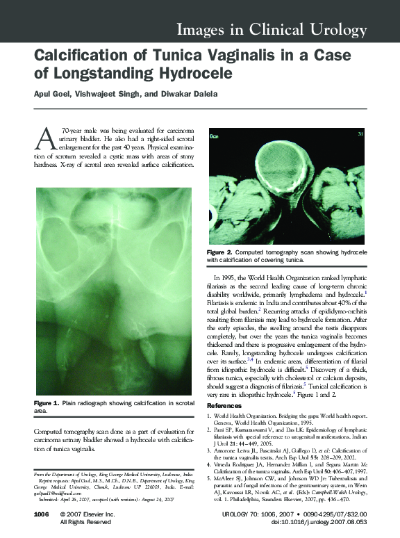 Pdf Calcification Of Tunica Vaginalis In A Case Of Longstanding