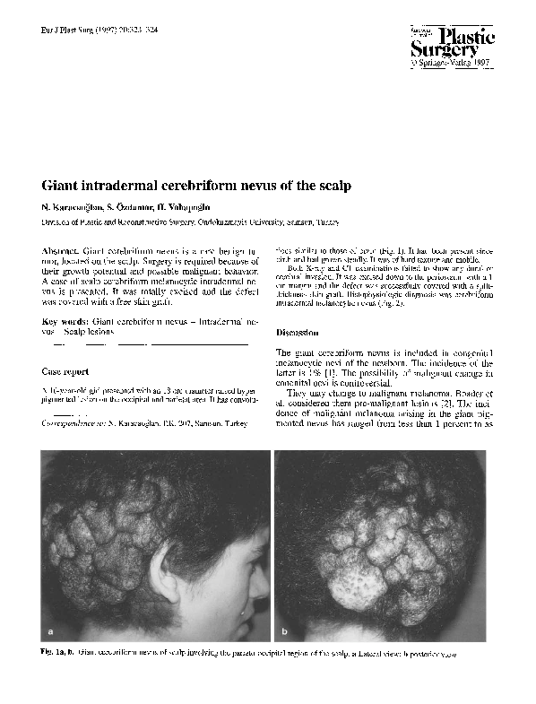 (PDF) Giant intradermal cerebritorm nevus of the scalp