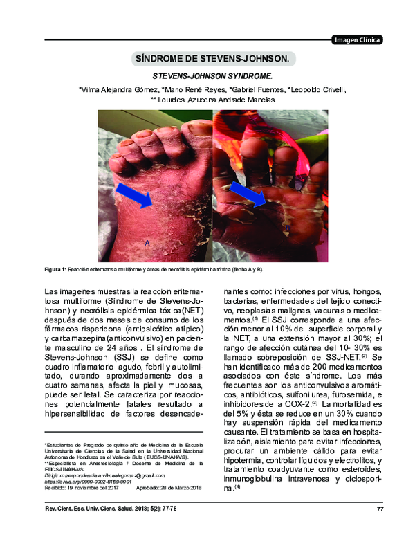 (PDF) Síndrome De Stevens-Johnson