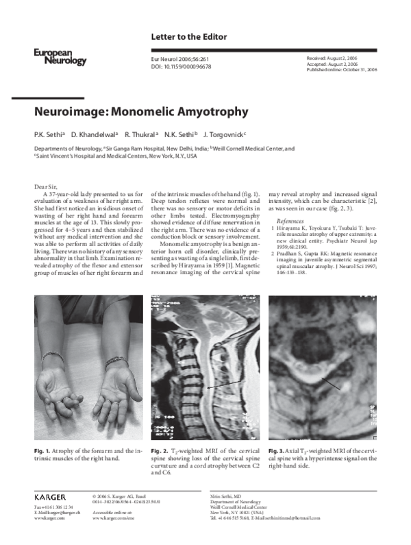 (PDF) Neuroimage: Monomelic Amyotrophy | Prahlad Sethi - Academia.edu