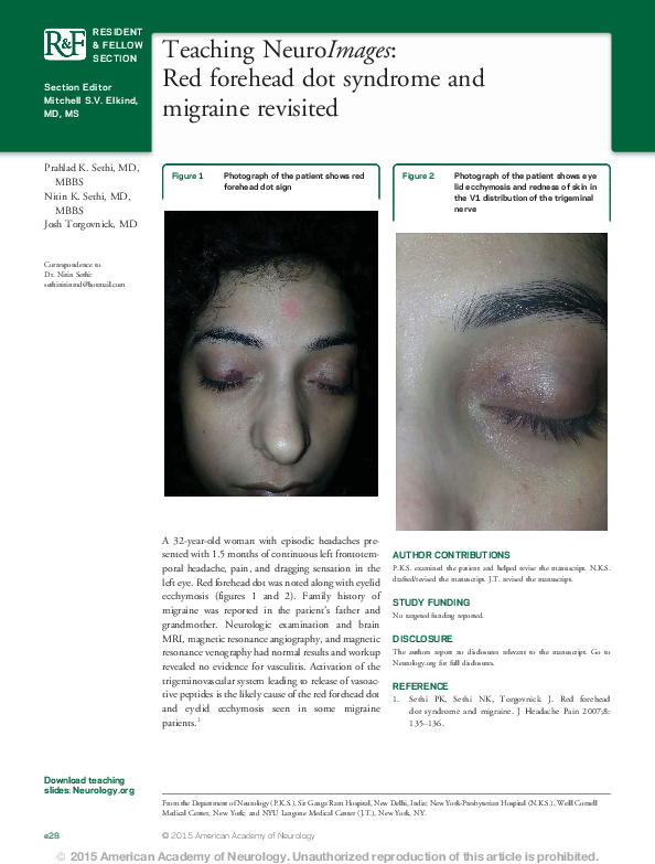 pdf-teaching-neuroimages-red-forehead-dot-syndrome-and-migraine