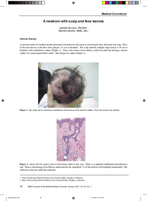 (PDF) A newborn with scalp and face lesions