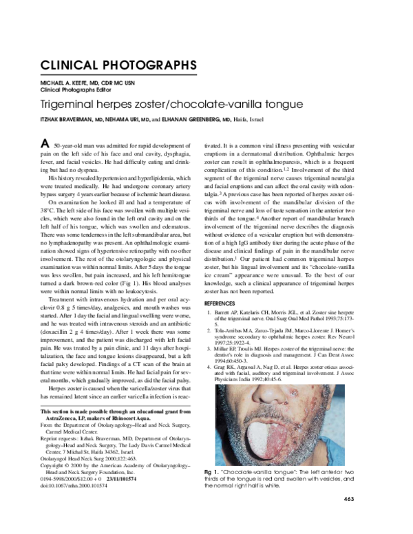 (PDF) Trigeminal herpes zoster/chocolate-vanilla tongue☆☆☆★
