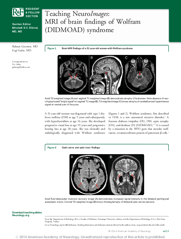 (PDF) Teaching NeuroImages: MRI of brain findings of Wolfram (DIDMOAD ...