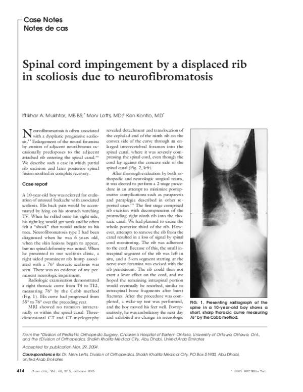 (PDF) Spinal cord impingement by a displaced rib in scoliosis due to ...