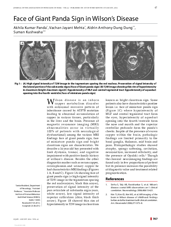 (PDF) Face of giant panda sign in Wilson's disease | Suman Kushwaha ...