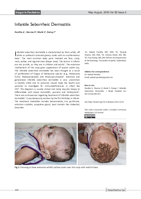 (PDF) Infantile Seborrheic Dermatitis