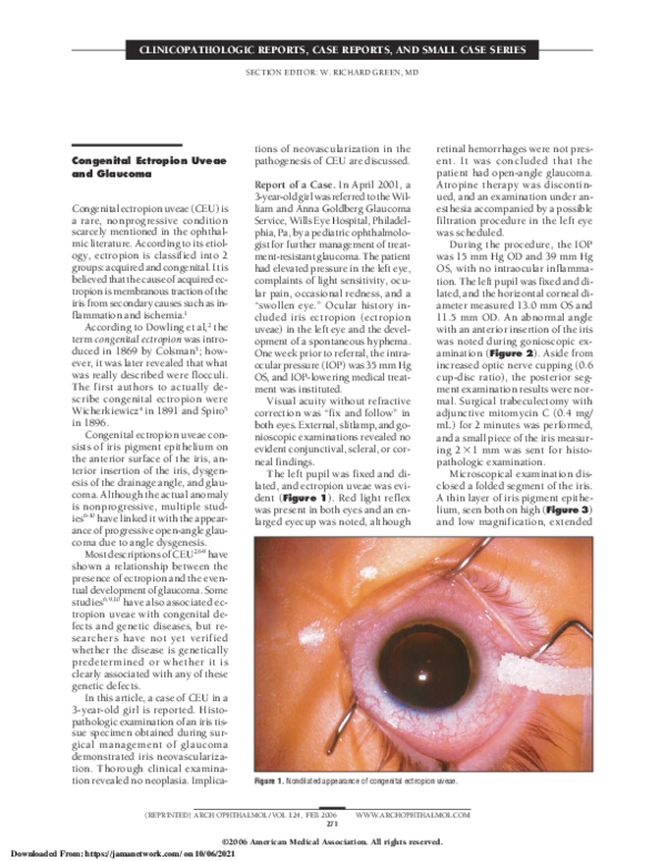(PDF) Congenital Ectropion Uveae and Glaucoma