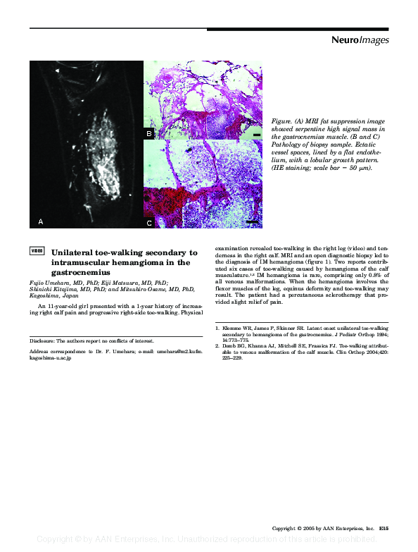 (PDF) Unilateral toe-walking secondary to intramuscular hemangioma in ...