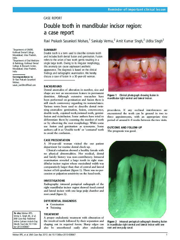 (PDF) Double tooth in mandibular incisor region: a case report