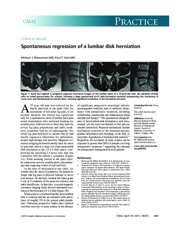 (PDF) Spontaneous regression of a lumbar disk herniation