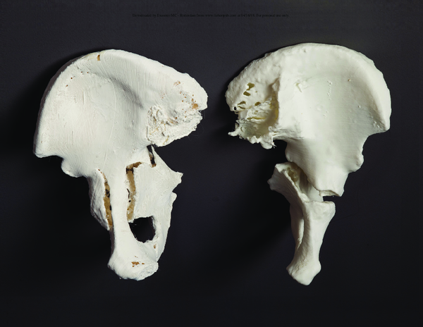 (PDF) The Value of 3D Printed Models in Understanding Acetabular Fractures