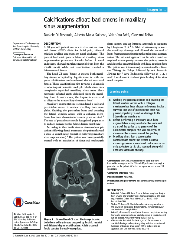 (PDF) Calcifications afloat: bad omens in maxillary sinus augmentation