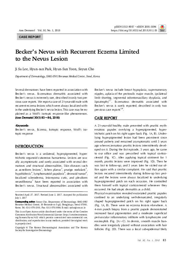 (PDF) Becker's Nevus with Recurrent Eczema Limited to the Nevus Lesion