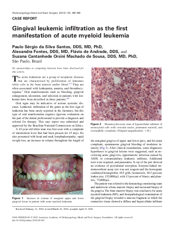 (PDF) Gingival leukemic infiltration as the first manifestation of ...
