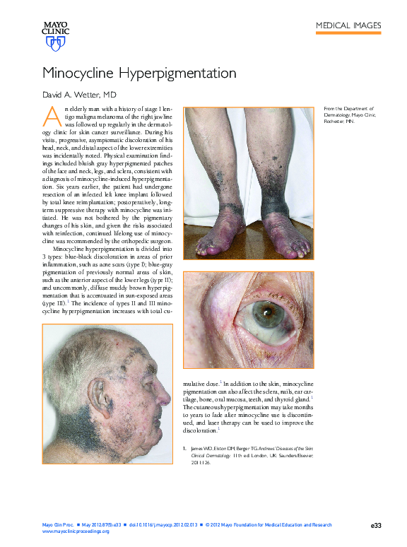 (PDF) Minocycline Hyperpigmentation