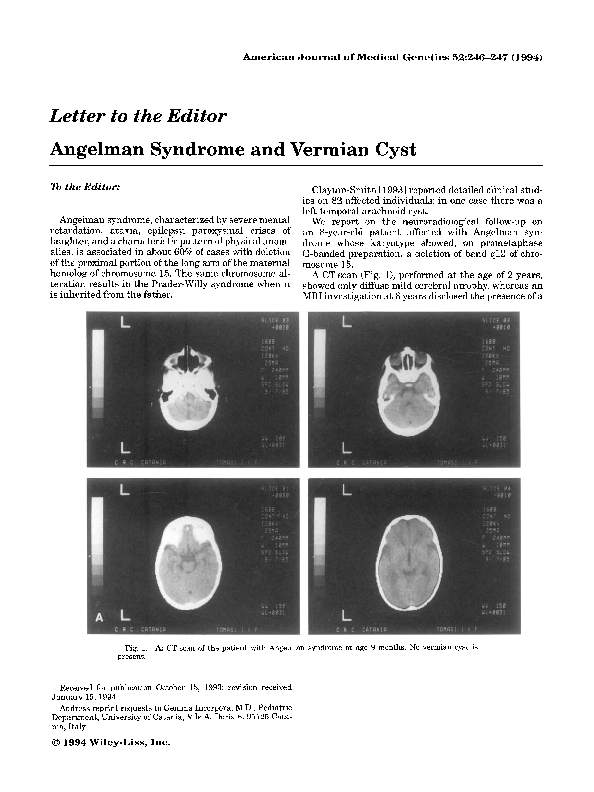 (PDF) Angelman syndrome and vermian cyst