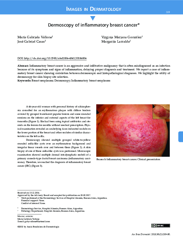 (PDF) Dermoscopy of inflammatory breast cancer