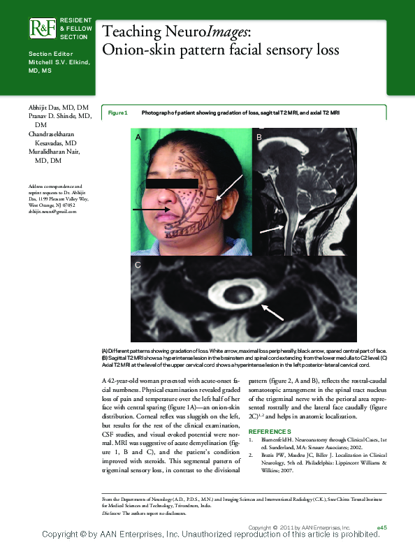 (PDF) Teaching NeuroImages: Onion-skin pattern facial sensory loss