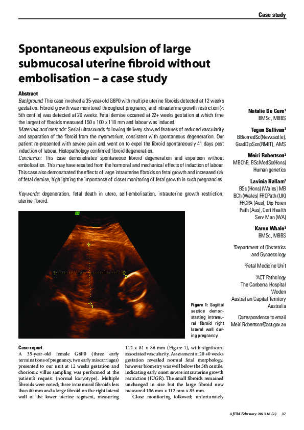 (PDF) Spontaneous expulsion of large submucosal uterine fibroid without ...