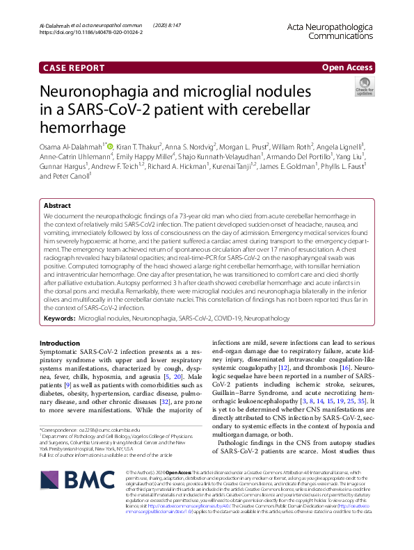 (PDF) Neuronophagia and microglial nodules in a SARS-CoV-2 patient with ...