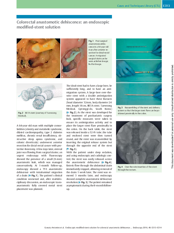 (PDF) Colorectal anastomotic dehiscence: an endoscopic modified-stent ...