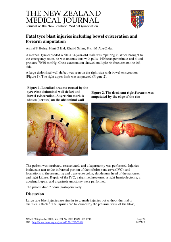 (PDF) Medical image. Fatal tyre blast injuries including bowel ...