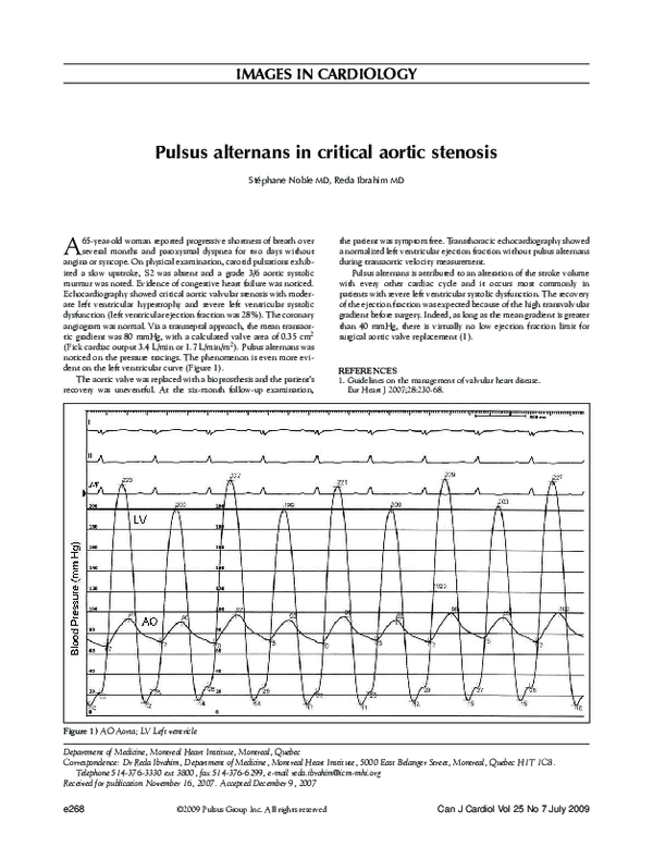 (PDF) Pulsus alternans in critical aortic stenosis | stephane noble ...