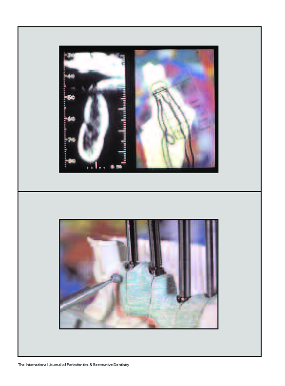 (PDF) Presurgical implant-supported prosthesis: technique for ...