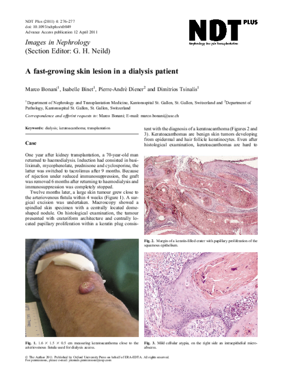 (PDF) A fast-growing skin lesion in a dialysis patient