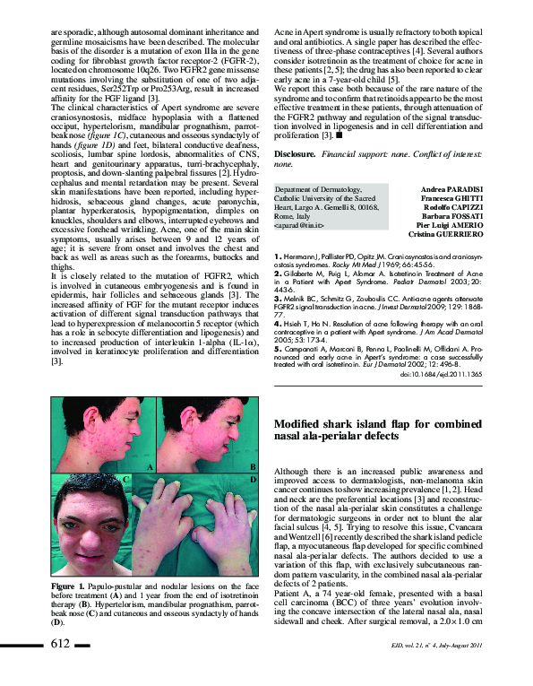 (PDF) Modified shark island flap for combined nasal ala-perialar defects