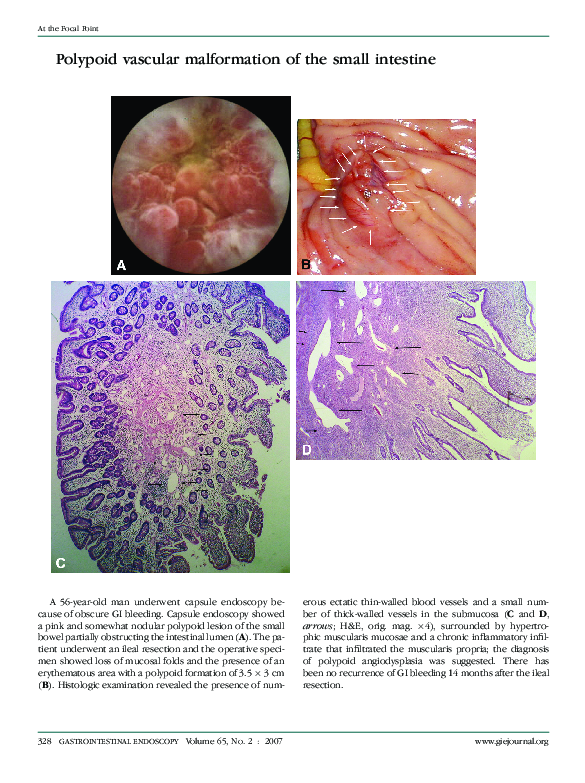 (PDF) Polypoid vascular malformation of the small intestine