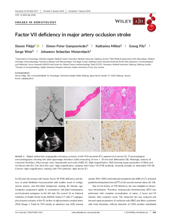 (PDF) Factor VII deficiency in major artery occlusion stroke