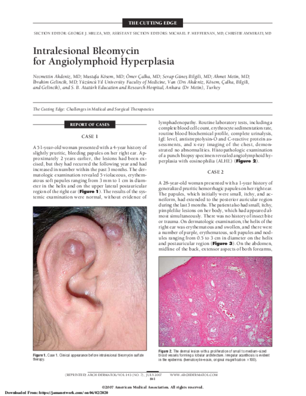(PDF) Intralesional Bleomycin for Angiolymphoid Hyperplasia