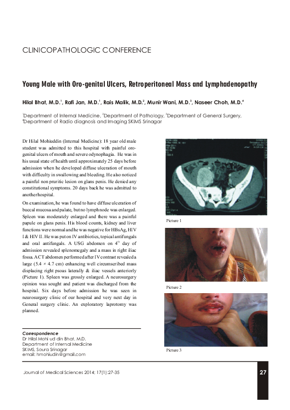 (PDF) CPC- Young Male With Oro-Genital Ulcers, Retroperitoneal Mass and ...