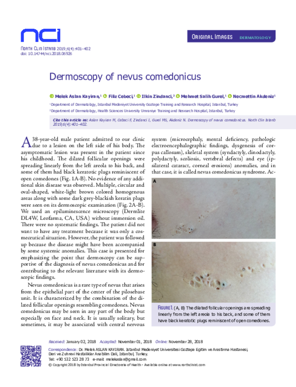 (PDF) Dermoscopy of Nevus Comedonicus