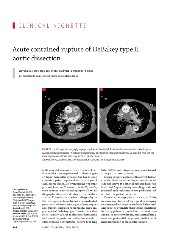 (PDF) Acute contained rupture of a type II DeBakey aortic dissection