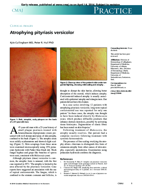 (PDF) Atrophying pityriasis versicolor