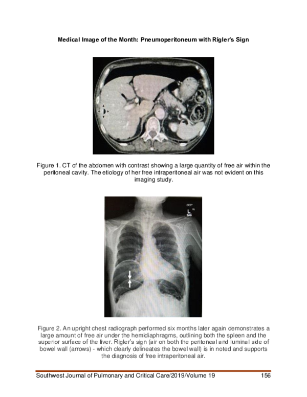 (PDF) Medical image of the month: pneumoperitoneum with Rigler's sign