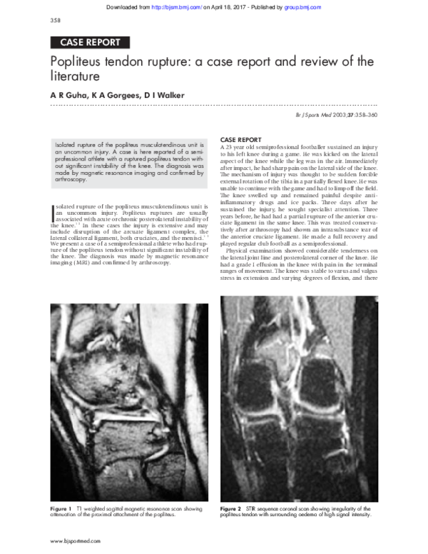 (PDF) Popliteus tendon rupture: a case report and review of the literature