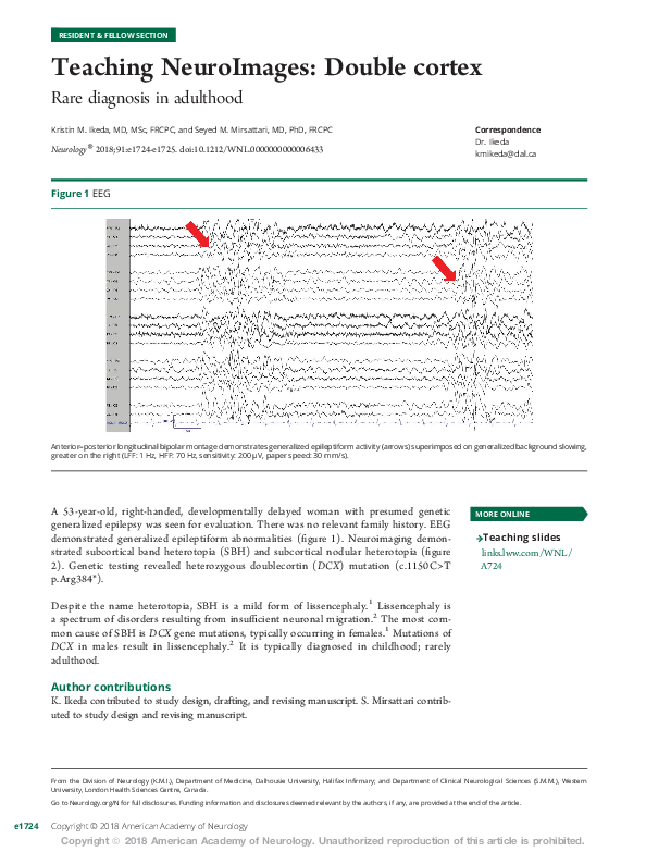 (PDF) Teaching NeuroImages: Double cortex: Rare diagnosis in adulthood