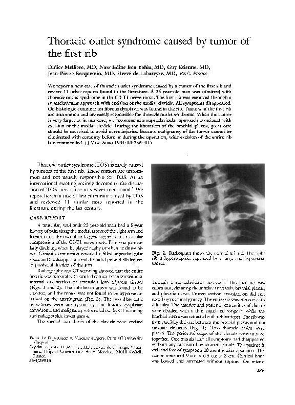(PDF) Thoracic outlet syndrome caused by tumor of the first rib