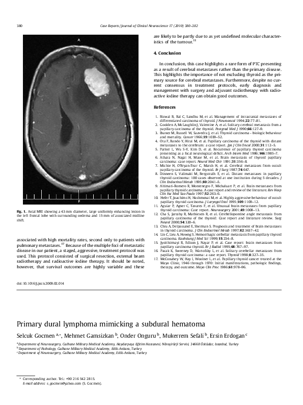 (PDF) Primary dural lymphoma mimicking a subdural hematoma