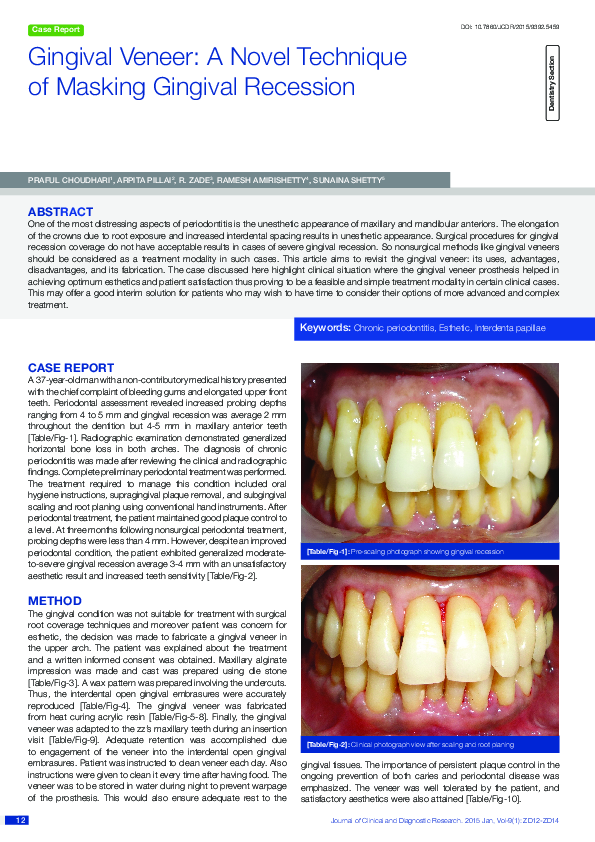 (PDF) Gingival veneer: a novel technique of masking gingival recession