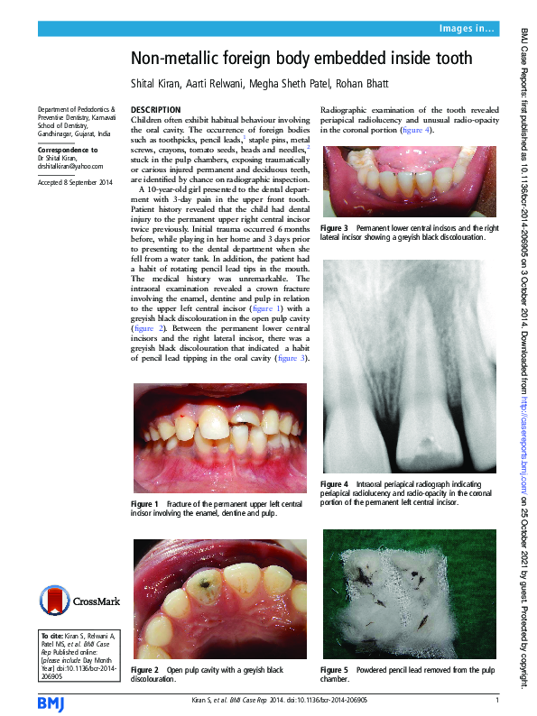 (PDF) Non-metallic foreign body embedded inside tooth | rohan bhatt ...