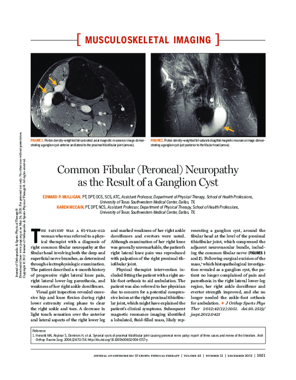 (PDF) Common Fibular (Peroneal) Neuropathy as the Result of a Ganglion Cyst