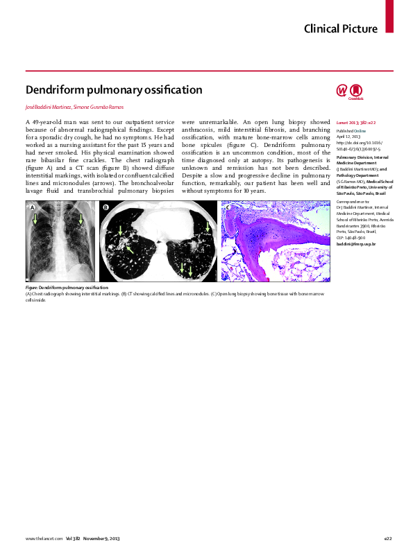 (PDF) Dendriform pulmonary ossification | Simone Gusmão Ramos Usp ...